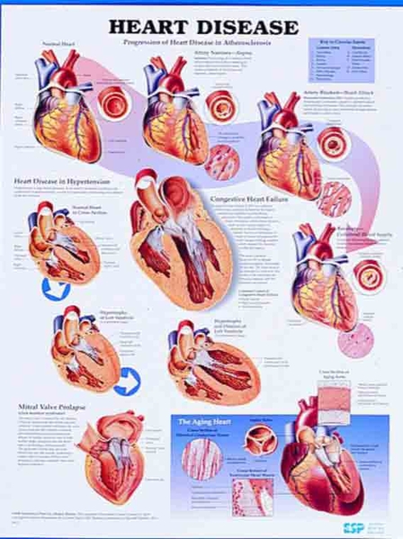 Heart Disease Wall Chart | HCE