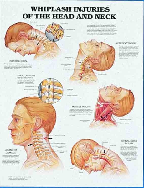 Whiplash Injuries Head & Neck Wall Chart | HCE