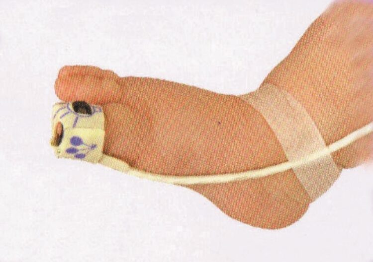 Nonin Infant Reusable Flex 2 - 20kg Big Toe Motion Situations | HCE