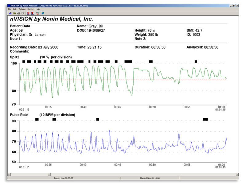 Nonin nVision PC Software for 3150 WristOx2 Monitor | HCE
