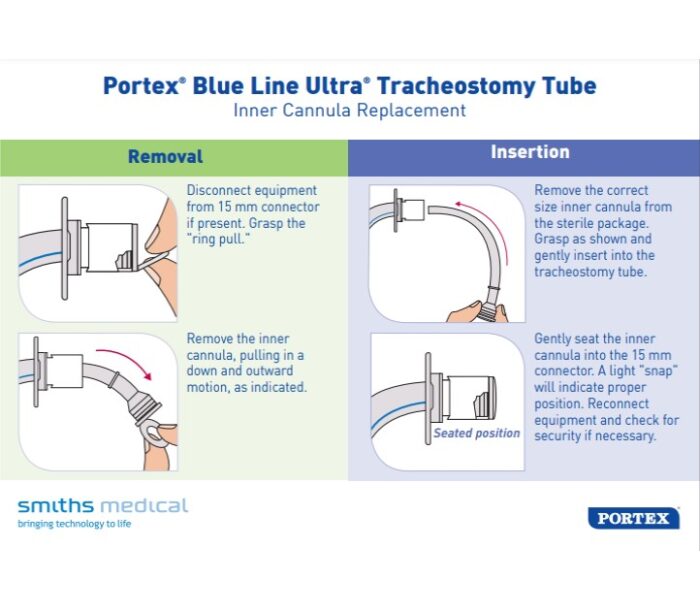 BLUselect Tracheostomy Tubes, Replacement Inner Cannula, Unfenestrated ...