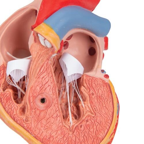 UK 3B Classic Heart with Left Ventricular Hypertrophy (LVH) | HCE