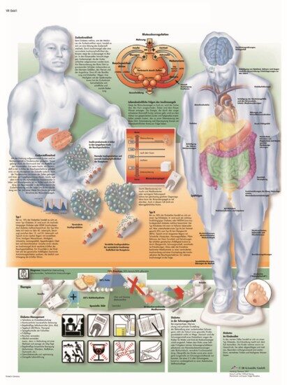 UK 3B Laminated Anatomical Wall Chart - Diabetes Mellitus | HCE