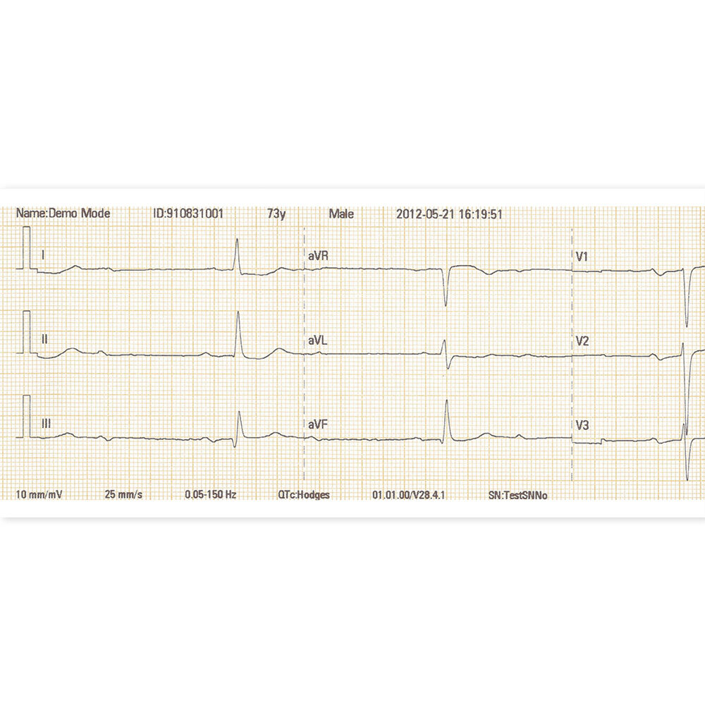 Mindray Thermal Recorder Paper Roll | HCE
